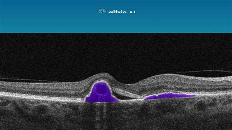 Altris Education Oct On Linkedin Animation Of An Atypical Case Of
