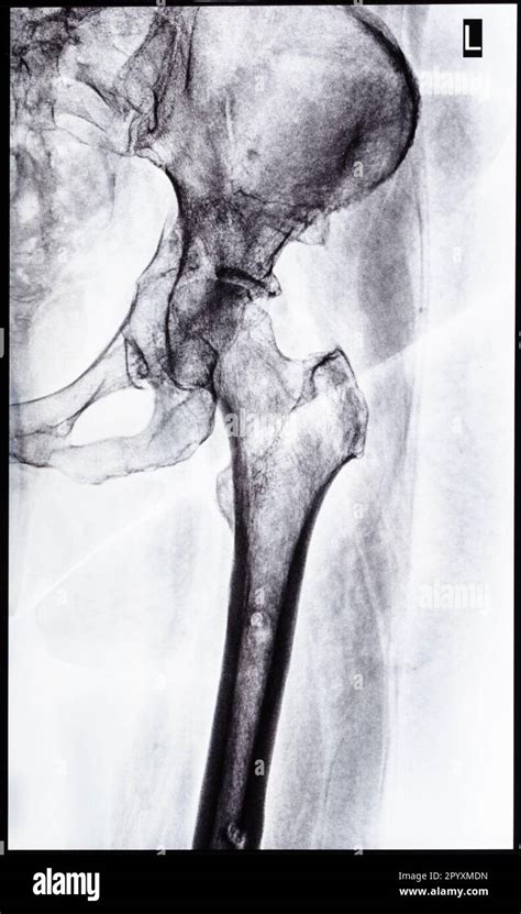 X Ray Of Junction Of Tibia And Pelvis After Healed Of Fracture Of