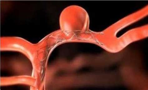 วชิรพยาบาลเปิดศูนย์ผ่าตัดหลอดเลือดสมองโป่งพอง