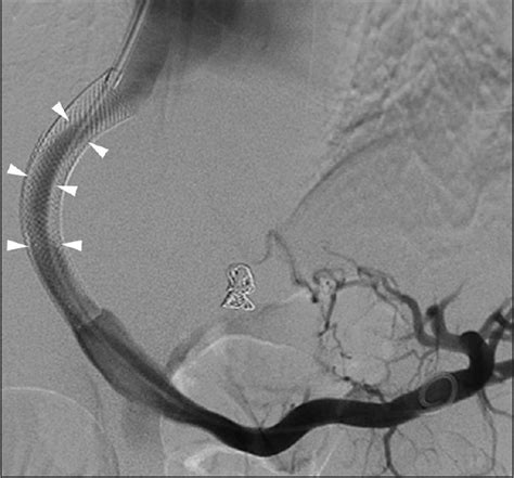 Angiographic Patterns Of Transjugular Intrahepatic Portosystemic Shunt Dysfunction And