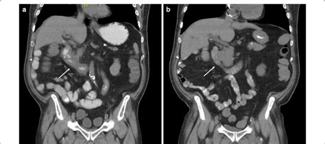 A Ct Abdomen Pelvis On Initial Presentation With Enteritis And Lack Of