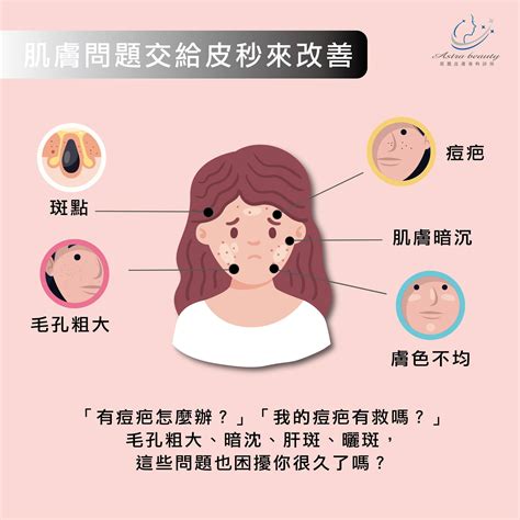 台南星麗皮膚專科診所 ️discovery Pico 探索皮秒 「年輕時的痘疤、凹疤，好煩腦該怎麼處理 」 Facebook