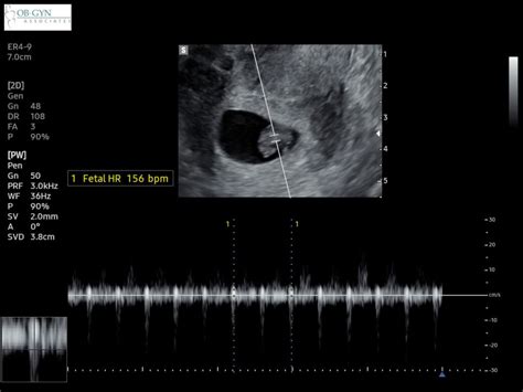 7 Week Ultrasound Heartbeat