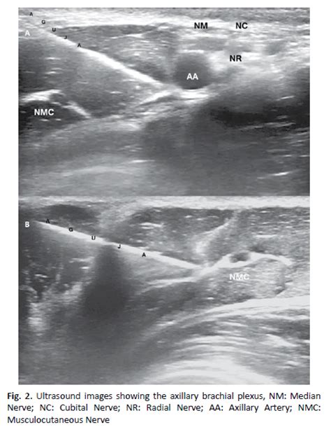 Ultrasoundguided Axillary Brachial Plexus Block