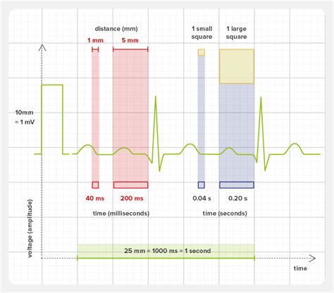 how to interpret the ecg