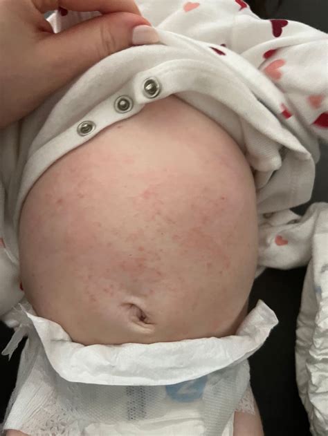 Viral Meningitis Rash