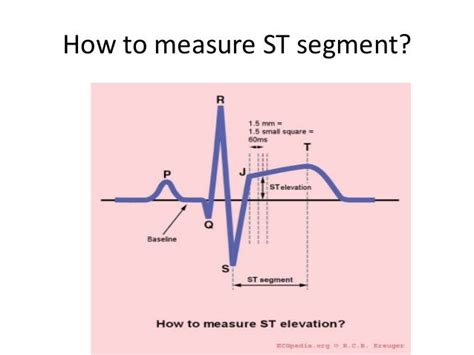 St Segment Elevations