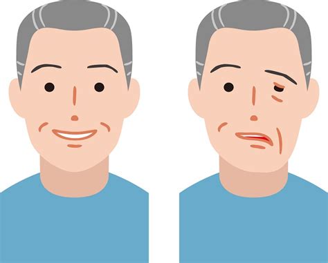 顔面神経麻痺の原因や症状と前兆植月診療所で漢方や神経ブロックで治療