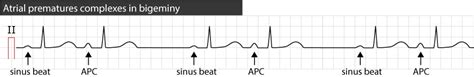Premature Atrial Contraction Premature Atrial Beat Complex Ecg