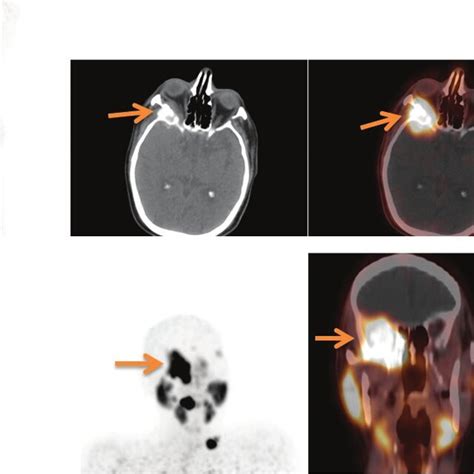 Secondary Malignancy Of The Penis Is A Rare Condition Despite Its Rich Download Scientific