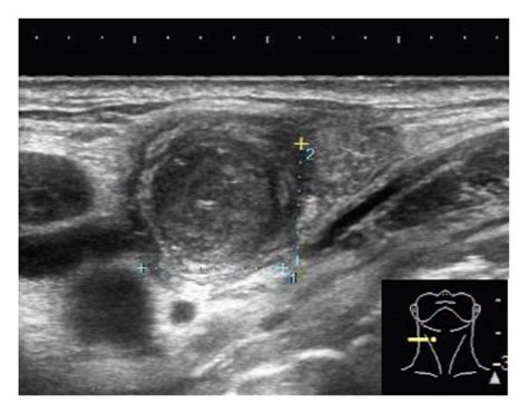 Clinical Findings Of The Patient A A Mass Lesion Of The Tongue An