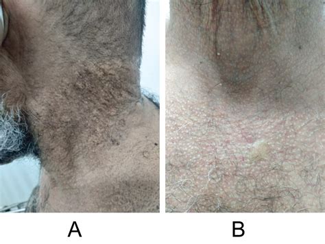 Pseudoxanthoma Elasticum Neck