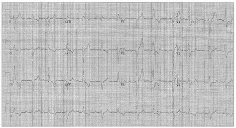 Bundle Branch Block