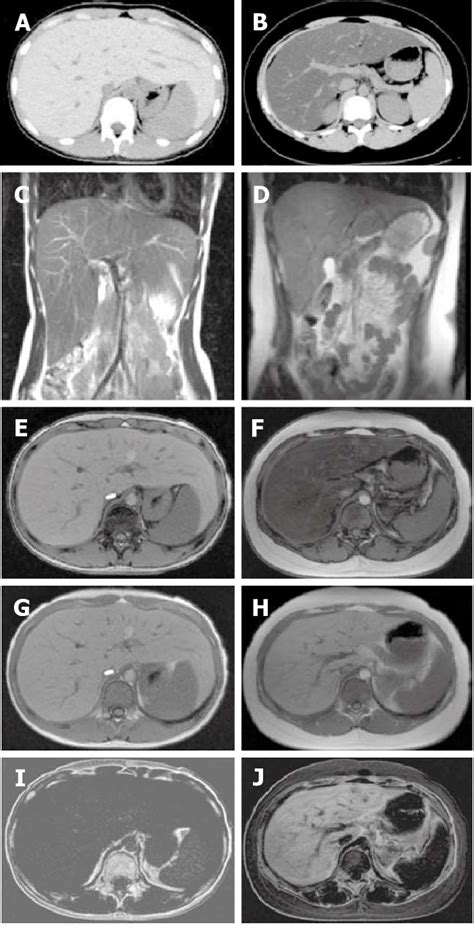 Fatty Liver Mri
