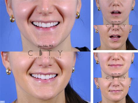 Lip Reconstruction Before And After