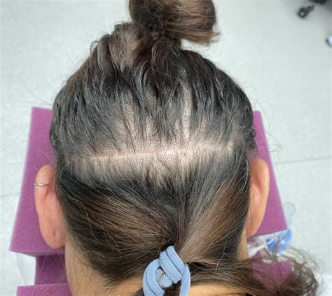 Plastic Surgery Case Study St Stage Scalp Tissue Expander Placement In Female Large Skull