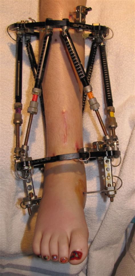 Limbreconstruction Home Page