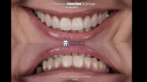 Flow Injection Technique Natrodent Kursy I Szkolenia Dla Techników Dentystycznych I Lekarzy
