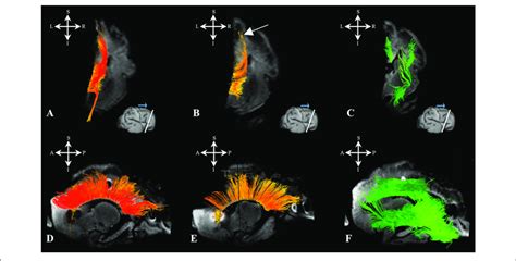 Callosal Fibers During Late Prenatal Period Reconstruction Of Download Scientific Diagram