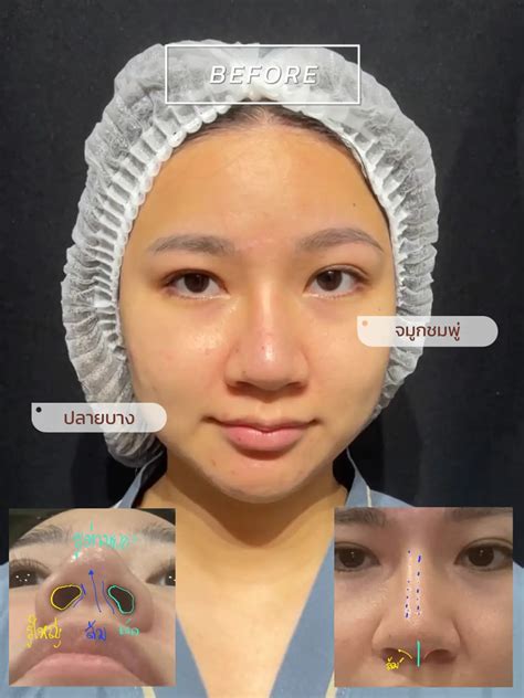 แก้จมูกทรงต้าเหนิง จมูกใหม่แบบสับ ฉบับสวยกินคน แกลเลอรีที่โพสต์โดย แพรวนี่รีวิว Lemon8