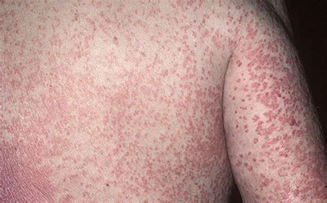 Erythrodermic Psoriasis Symptoms Pictures Symptoms And Pictures