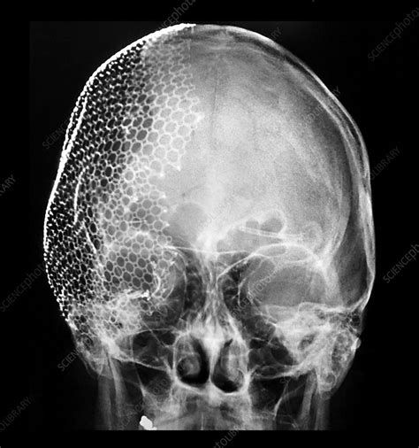 Mesh Cranioplasty X Ray Stock Image C039 4236 Science Photo Library