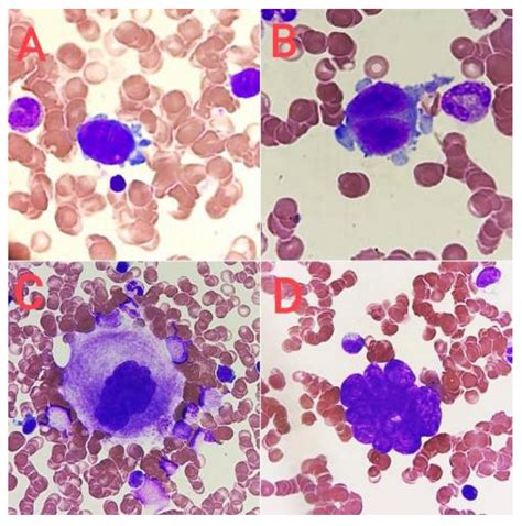 The Role Of Megakaryocyte Assessment In Bone Marrow Cytology