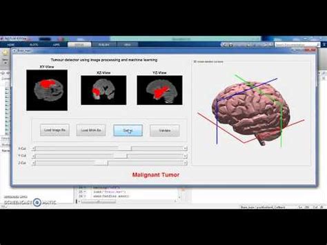 Detect Tumour From Brain MRI Matlab MatlabWorks