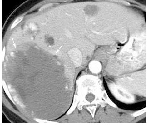 Axial Multiplanar Reconstruction Of Liver Ct Scan Obtained At Portal Download Scientific