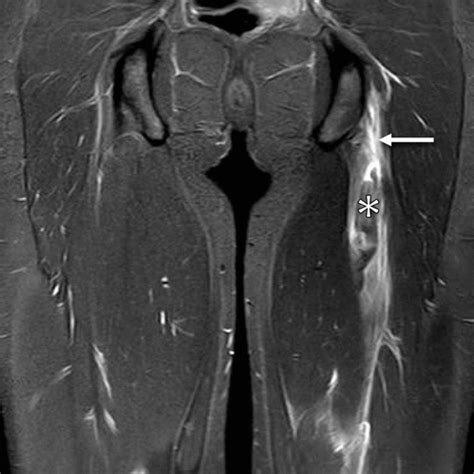 Mri And Us In Hamstring Sports Injury Assessment Anatomy Imaging