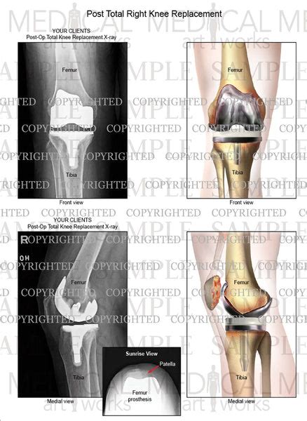 Right Knee Total Knee Replacement Post Op X Rays — Medical Art Works