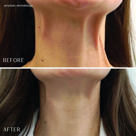 Treatment Of The Neck And Lower Face With Botulinum Toxin Mdedge