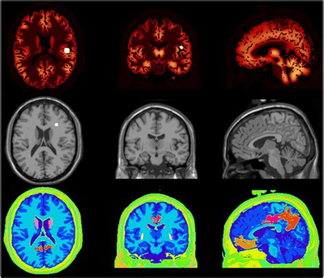 Transaxial Slice Left Column Coronal Slice Middle Column And
