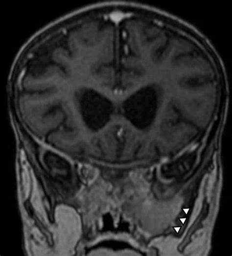 Pro B Cell Lymphoblastic Leukaemia Presenting With Multiorgan