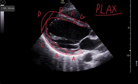 Heart Wall Segments And Coronary Arterial Territories For Echo Flashcards Quizlet