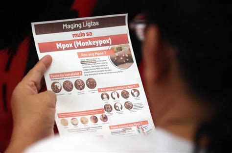 Baguio Records First Mpox Case