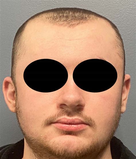 Male Temporal Reduction Front 2 Dr Barry Eppley Copy Explore Plastic Surgery