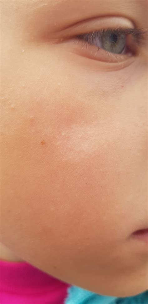 Белое пятно на лице Вопрос дерматологу 03 Онлайн