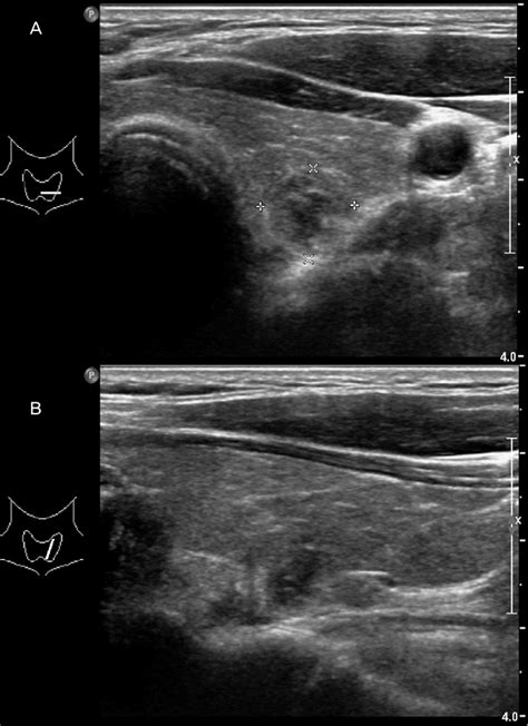 A Transverse View Of The Left Thyroid Gland B Longitudinal View Of