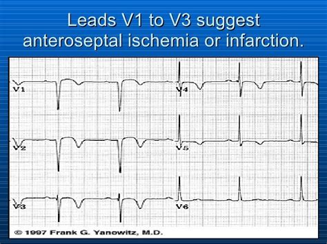 Ecg Interpretation