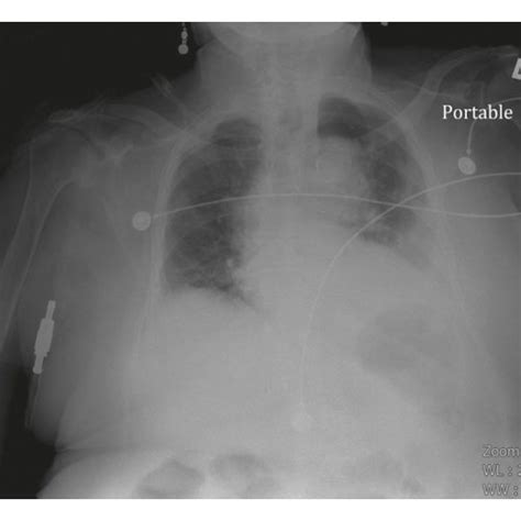 Diffuse Gaseous Distention Of The Bowel Consistent With Ileus Seen On
