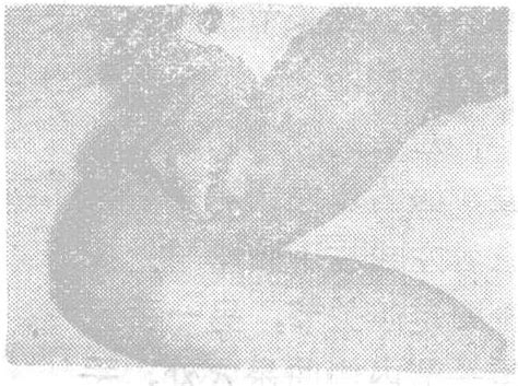 揉血海法 三宝合璧 医学