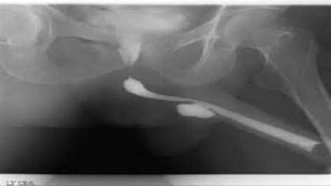 Radiographic Procedure Rgu And Mcug Saroj Pptx