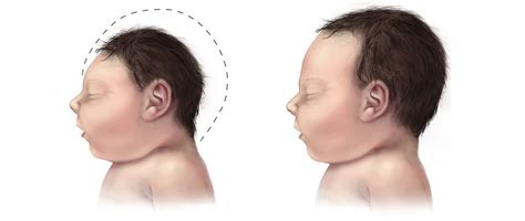 Microcephaly Causes Symptoms Diagnosis Prognosis Treatment