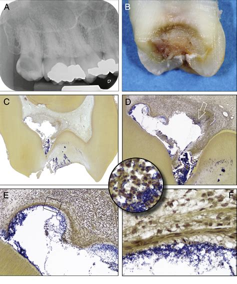 Figure 3 From Correlation Between Clinical And Histologic Pulp Diagnoses Semantic Scholar