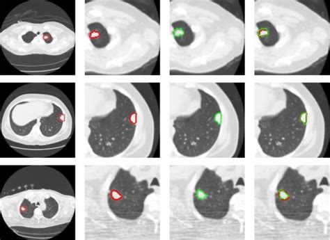 Examples Of Segmentation Results On The Lidc Dataset Using Gmmfcm