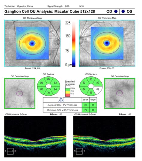 Octcases Glaucoma Case 6
