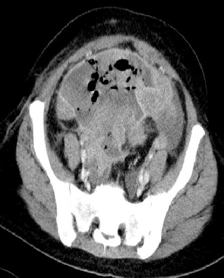 Figure Pelvic And Abdominal Computed Tomography Shows Massive Turbid Download Scientific