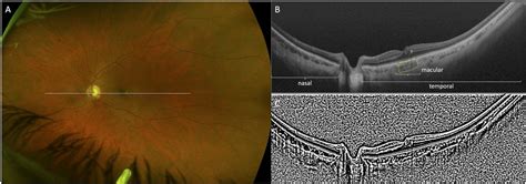 Measurement Of The Choroidal Vascularity Index Cvi On Extended Field