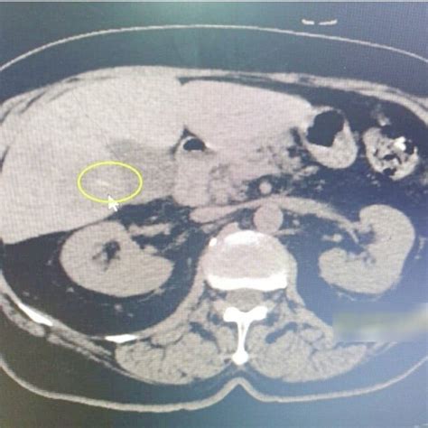 Contrast Enhanced Ct Scan Reveals An Elongated Hyperdense Structure Download Scientific Diagram